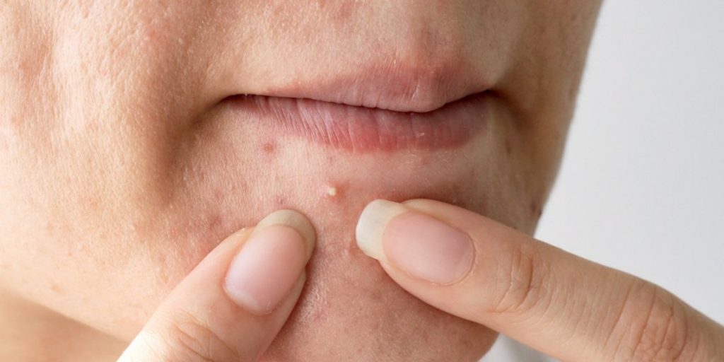 The Dangers of Pimple Popping – Dermaroller® Micro-Needling | Collagen ...